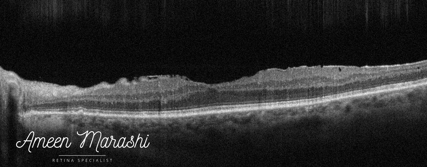 Cellophane maculopathy