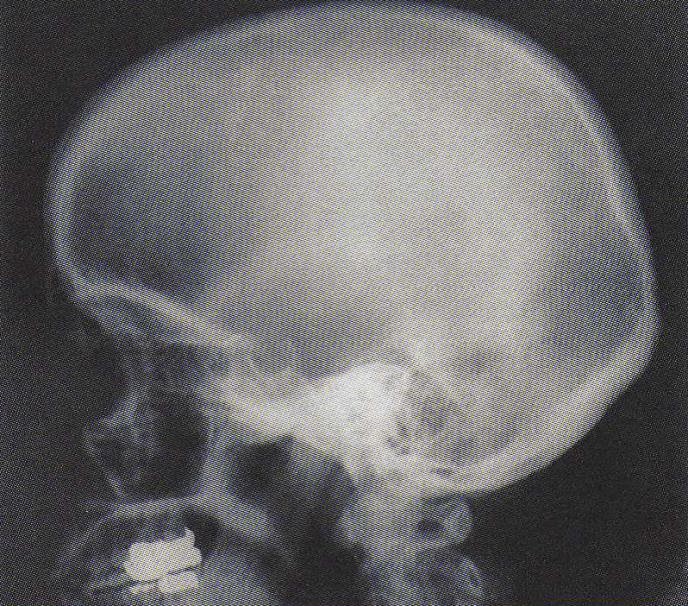 Sahabat Afterego: Prosedur Pemeriksaan Radiograf Cranium