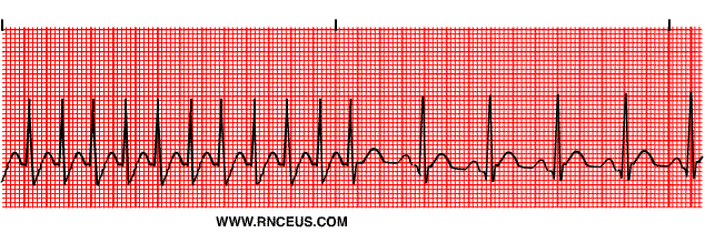 陣發性心房心搏過速 Paroxysmal atrial tachycardia, PAT