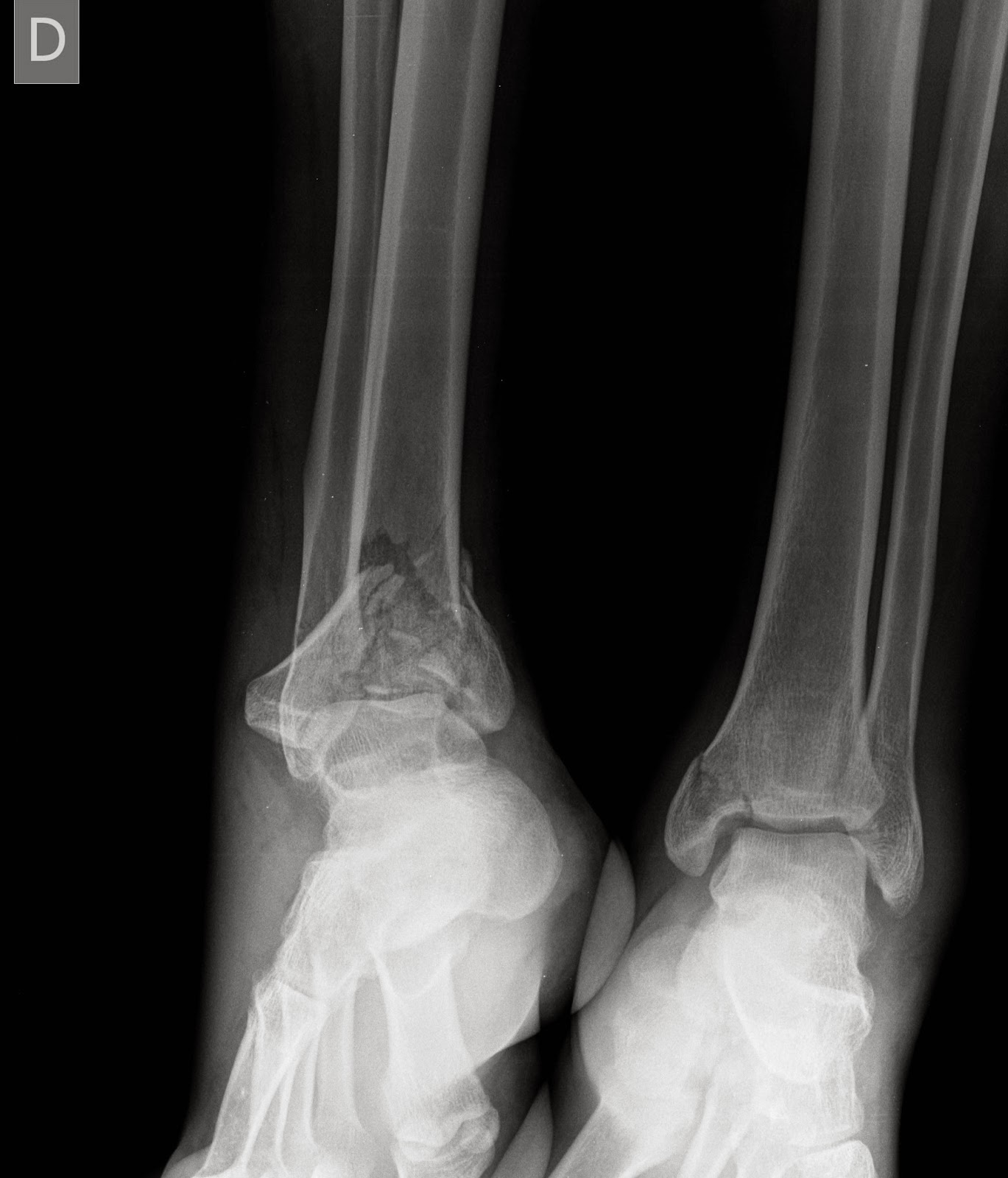 Fratura Maleolo Lateral Cid - RETOEDU