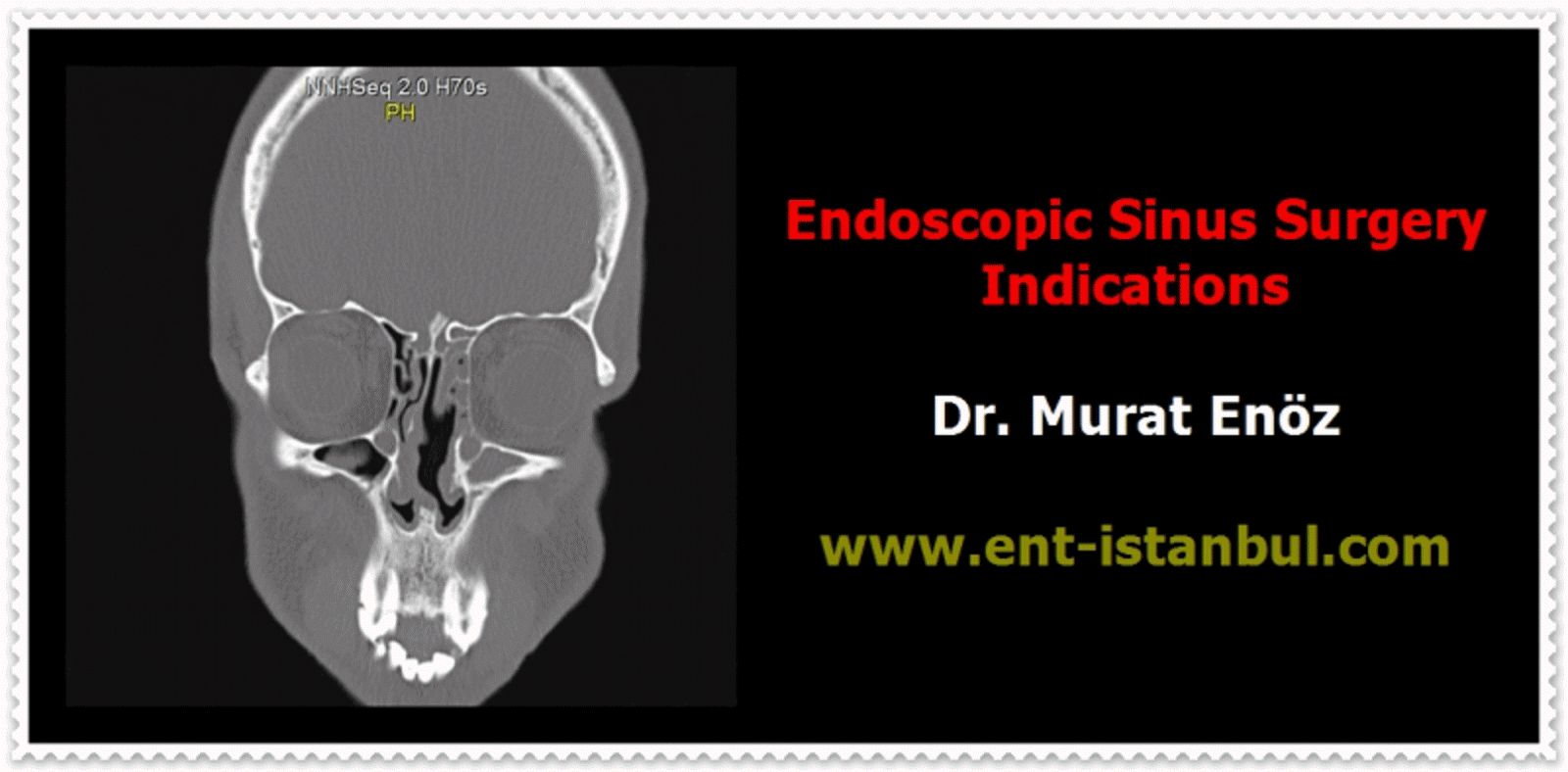 Endoscopic Sinus Surgery