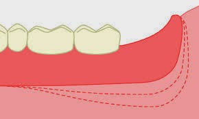 Medical Treatment Pictures-for Better Understanding: Mylohyoid Ridge ...
