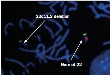 Diagnosis of DiGeorge syndrome