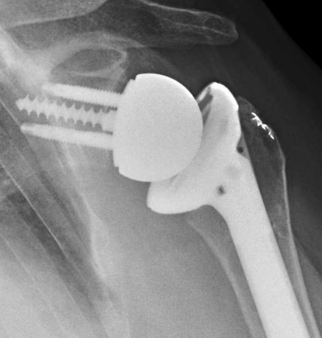 Shoulder Arthritis / Joint Replacement : Reverse total shoulder ...