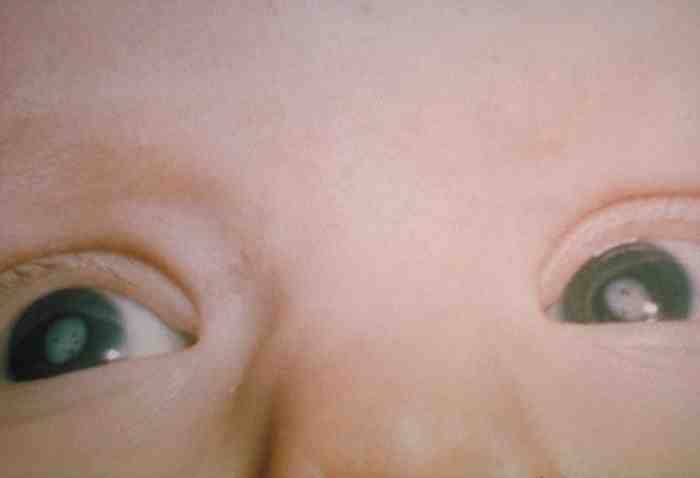 Congenital cataract - types, causes, features, treatment - DNB Pediatrics
