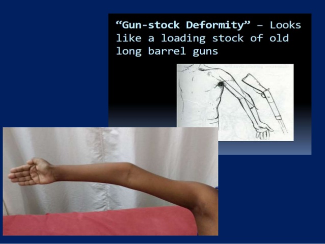 Supracondylar fracture of Humerus