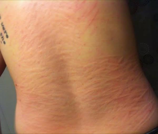 What Is Dermatographia Symptoms Cause Risk Factors And How To Treat what-is-dermatographia-symptoms-cause-risk-factors-and-how-to-treat