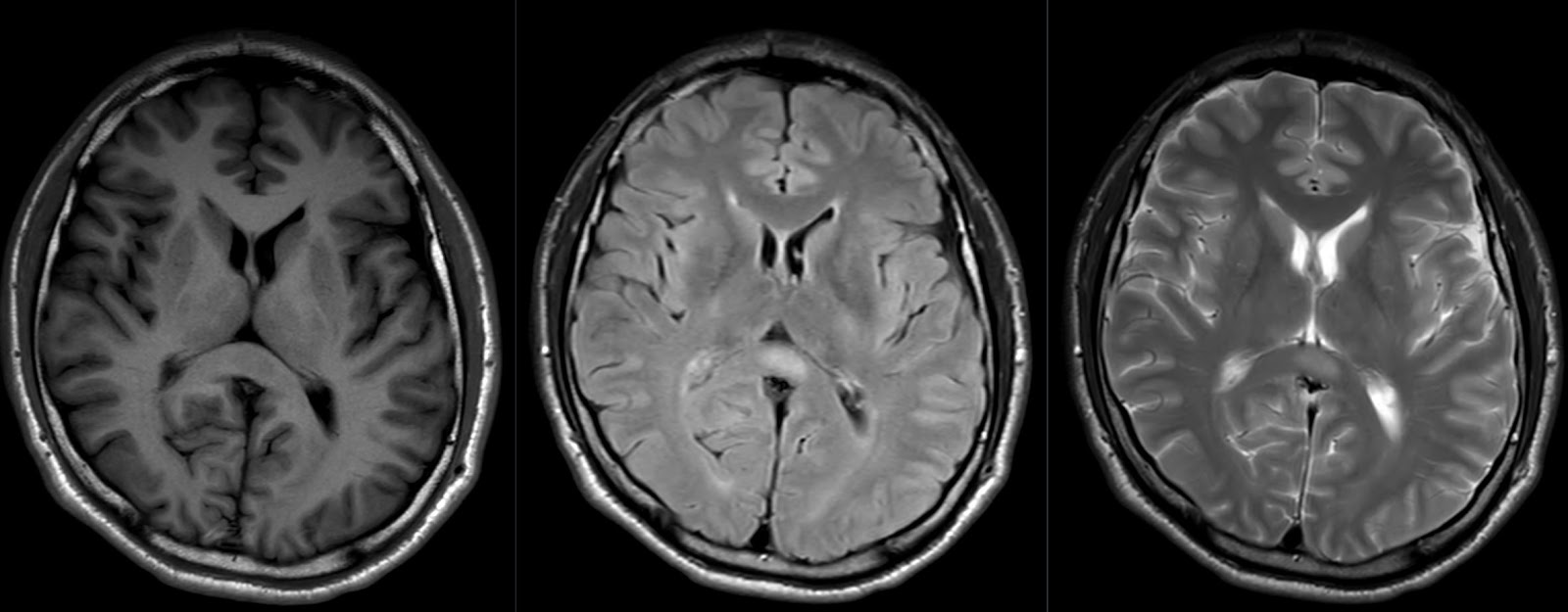 Cytotoxic Lesions Of the Corpus Callosum (CLOCCs)
