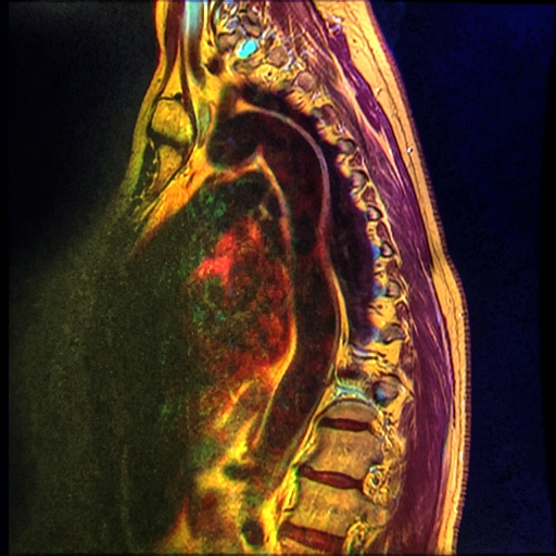 Nevit's blog: Dorsal Spine Color MRI