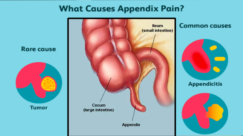 Appendicitis: Pain and Symptoms, Function and Location - ArtikuloBlogazine