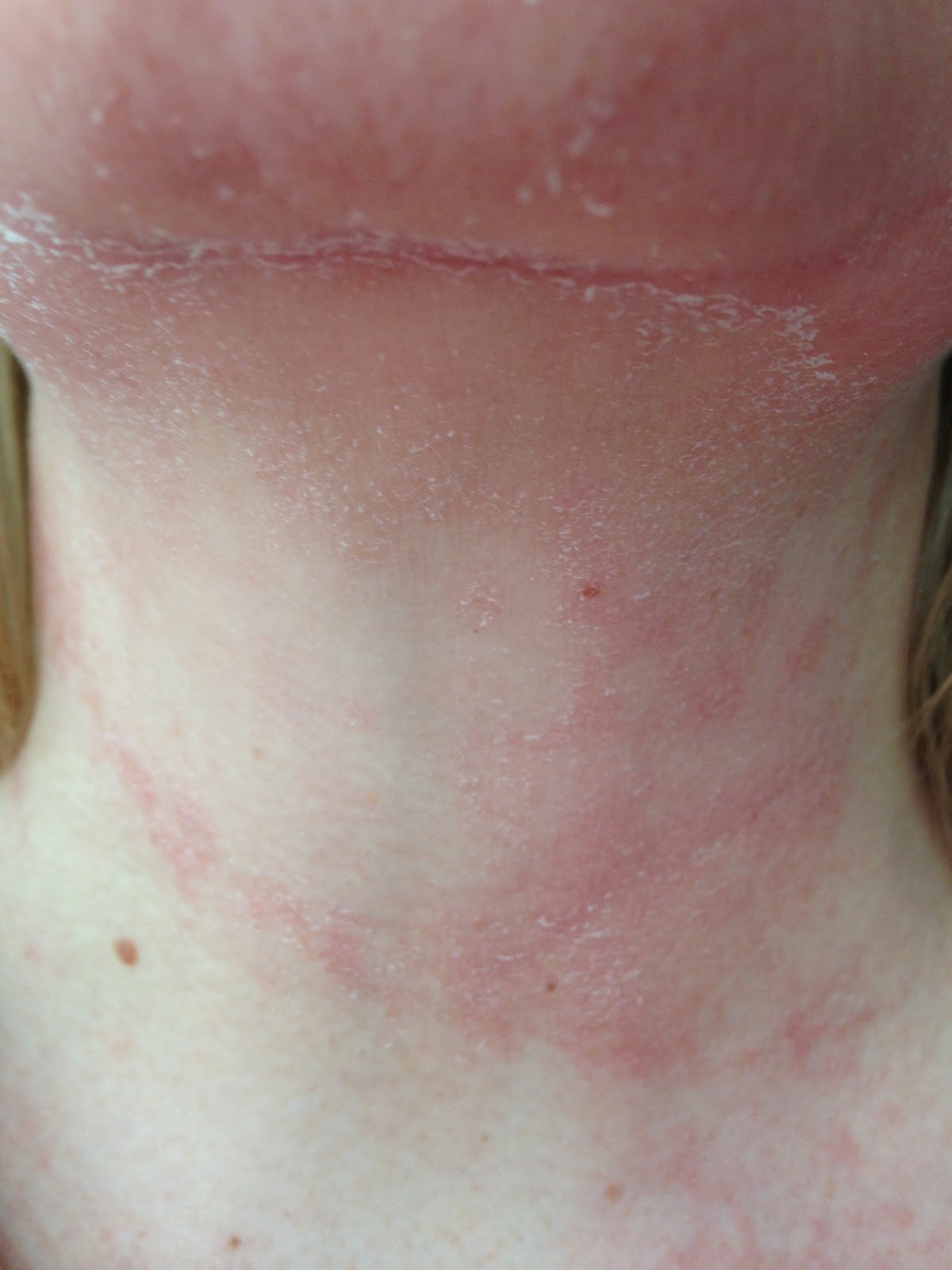 My Obagi Nu-Derm experience : Week 2 - My face is settling to a pink ...