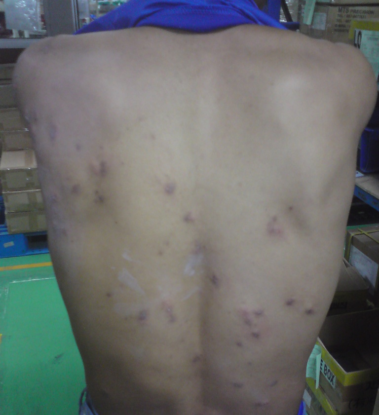 Penyakit Cacing Kulit atau CUTANEOUS LARVA MIGRAN “CREEPING ERUPTION”