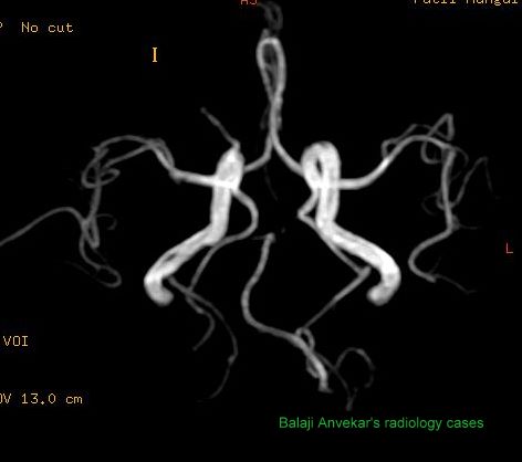 Posterior Cerebral Artery Angiogram