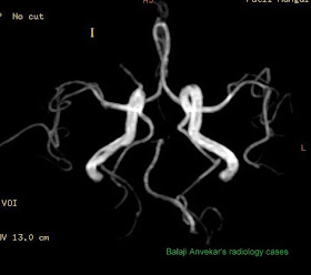 Dr Balaji Anvekar FRCR: Fetal PCA MR Angiography of Brain