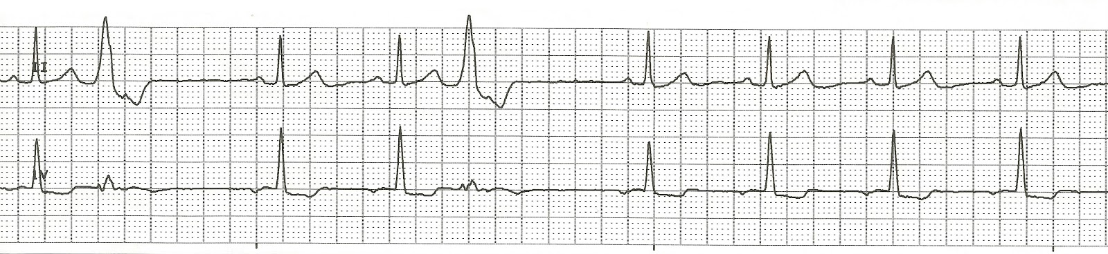ECG Rhythm Strips 88