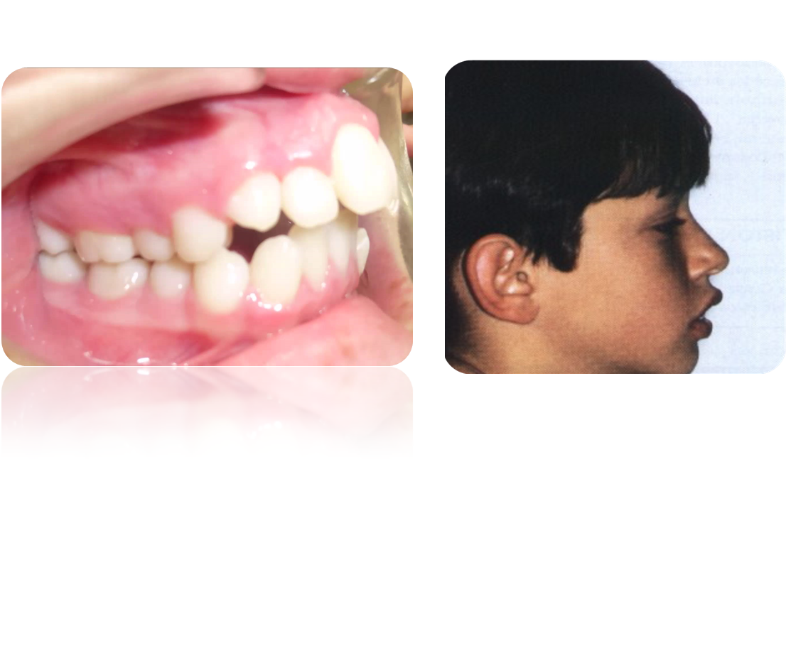 MALOCLUSIONES CLASE II