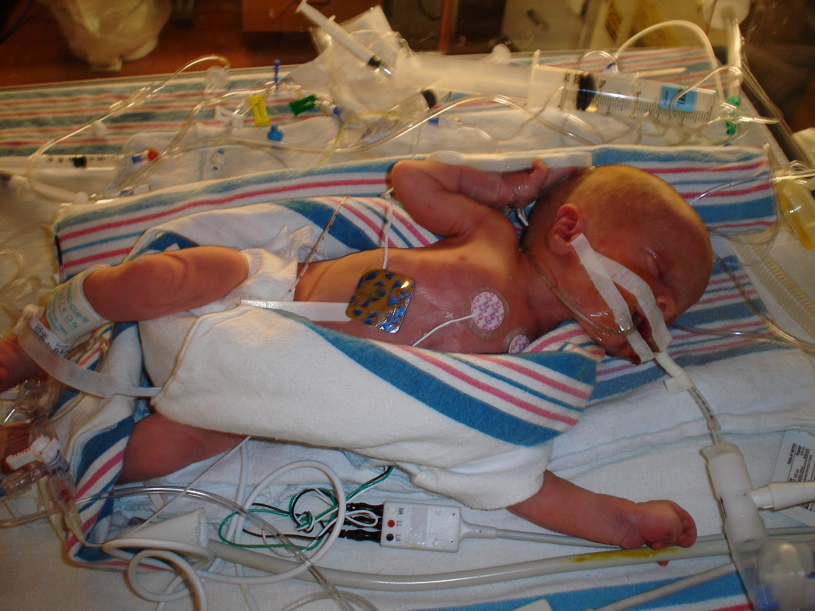 Raising Diaphragmatic Hernia Children.: Featured Child~ Benjamin