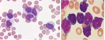 Mature B, T, and NK Cell Neoplasms - Prolymphocytic leukemia (PLL)
