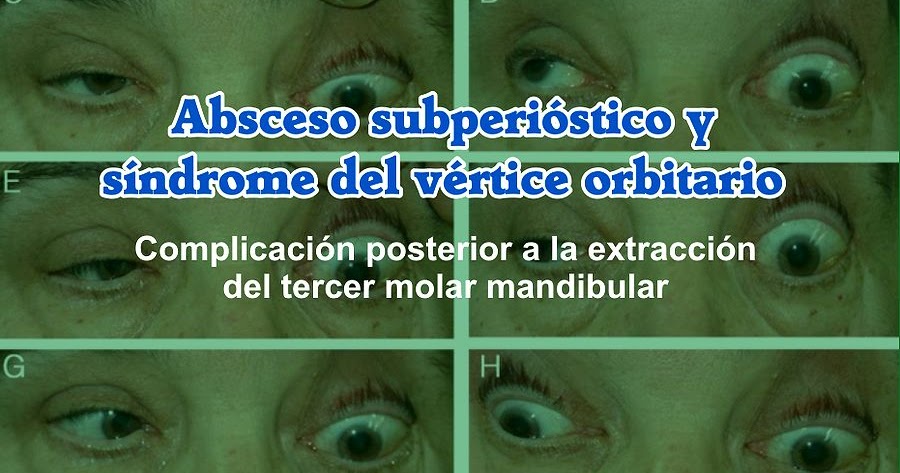 PDF: Absceso subperióstico y síndrome del vértice orbitario ...