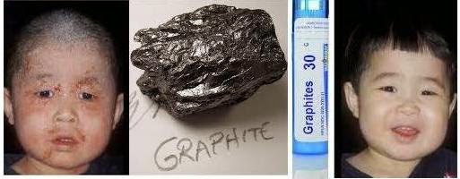 Homeopathy Medicine : Graphites Medicine for Skin Deseases