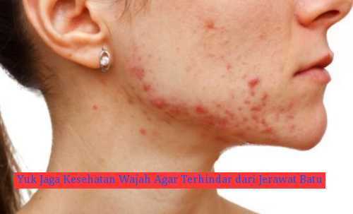 7 Pengobatan Jerawat Batu Secara Alami