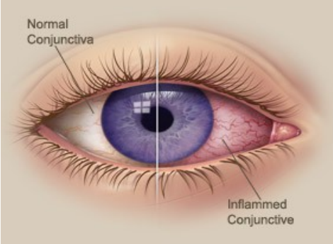 Jenis Jenis Konjungtivitis yang Harus Anda Ketahui ~ Manfaat dan ...