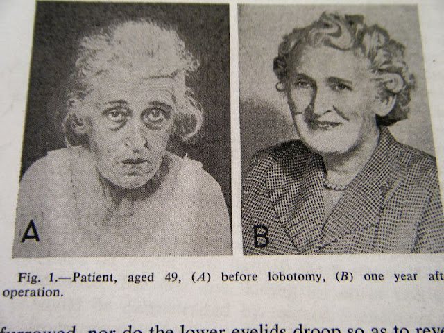 Do You Need a Lobotomy? Just Look at the Results From These Before and ...