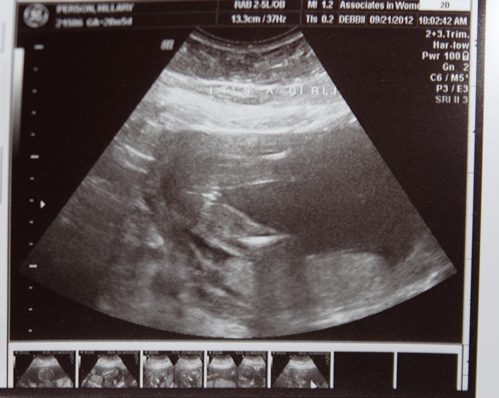 Ultrasounds: Early Gender Ultrasounds