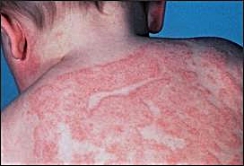 DESI M.B.: PREVENCIÓN DE LA DERMATITIS SOLAR.