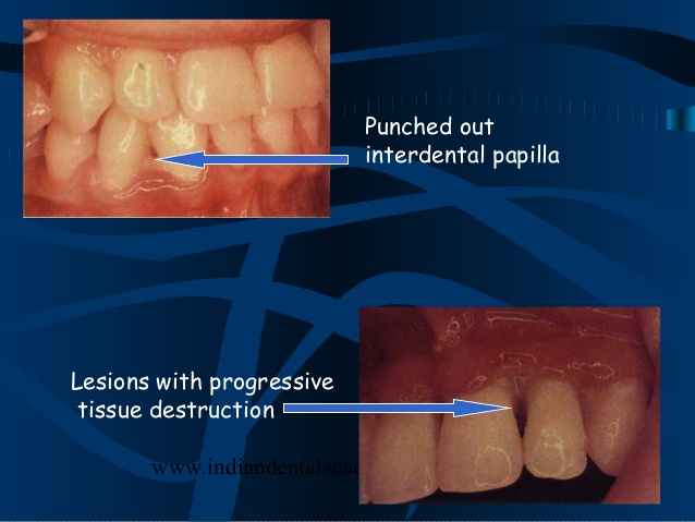 Dental Library: Acute necrotising ulcerative gingivitis(ANUG)