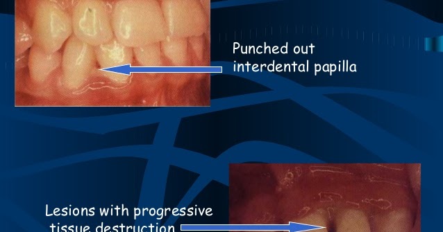 Dental Library: Acute necrotising ulcerative gingivitis(ANUG)