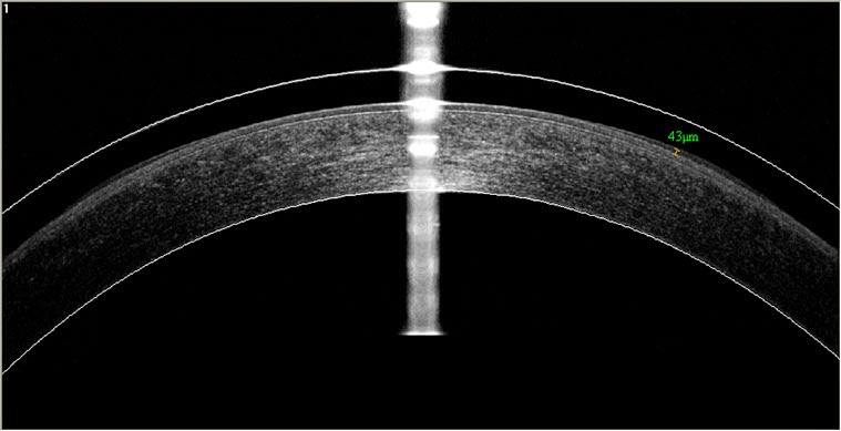 Orthokeratology: The Mechanics of How it Works - Eyedolatry