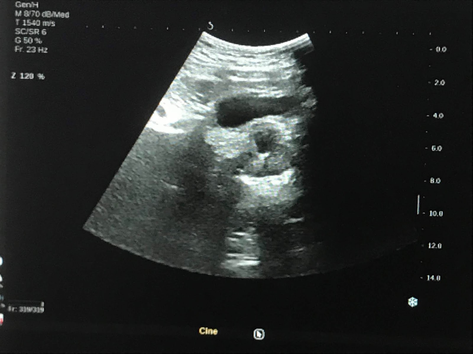 VIETNAMESE MEDIC ULTRASOUND: CASE 572: PROSTATE CANCER, Dr PHAN THANH ...