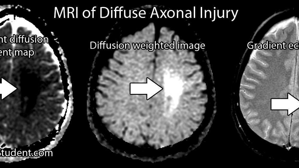 Diffuse axonal injury