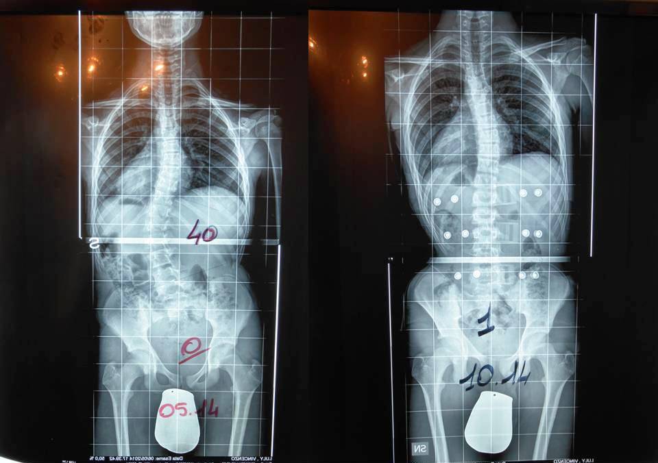 Despre corsetul Cheneau :: Corset scolioza / scoliosis braces