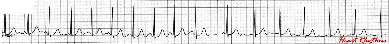 ECG Rhythms: WAP/MAR/MAT/Sinus arrhythmia