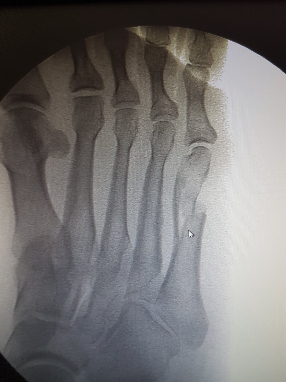 Podo Basas al Día: Alargamiento de gastrocnemio. Papilomas con ...