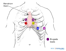 Mill Hill Ave Command: The most difficult step in obtaining an ECG.
