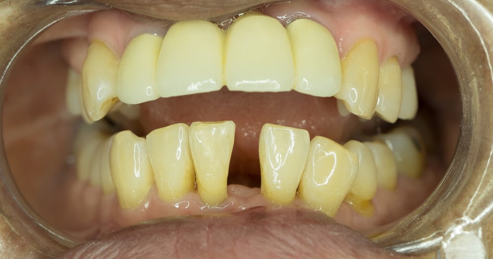 Edentulism Causes Symptoms Prevention And Treatment