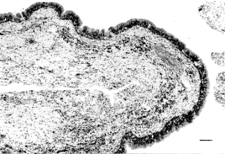 Chronic Hyperplastic Pulpitis ( Pulp polyp )