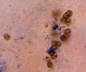 Penyakit Kromomikosis dan Pengobatannya - SKIN MAGZ