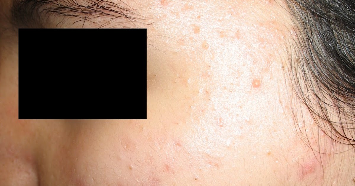 Dermapixel: Dame algo para los granos