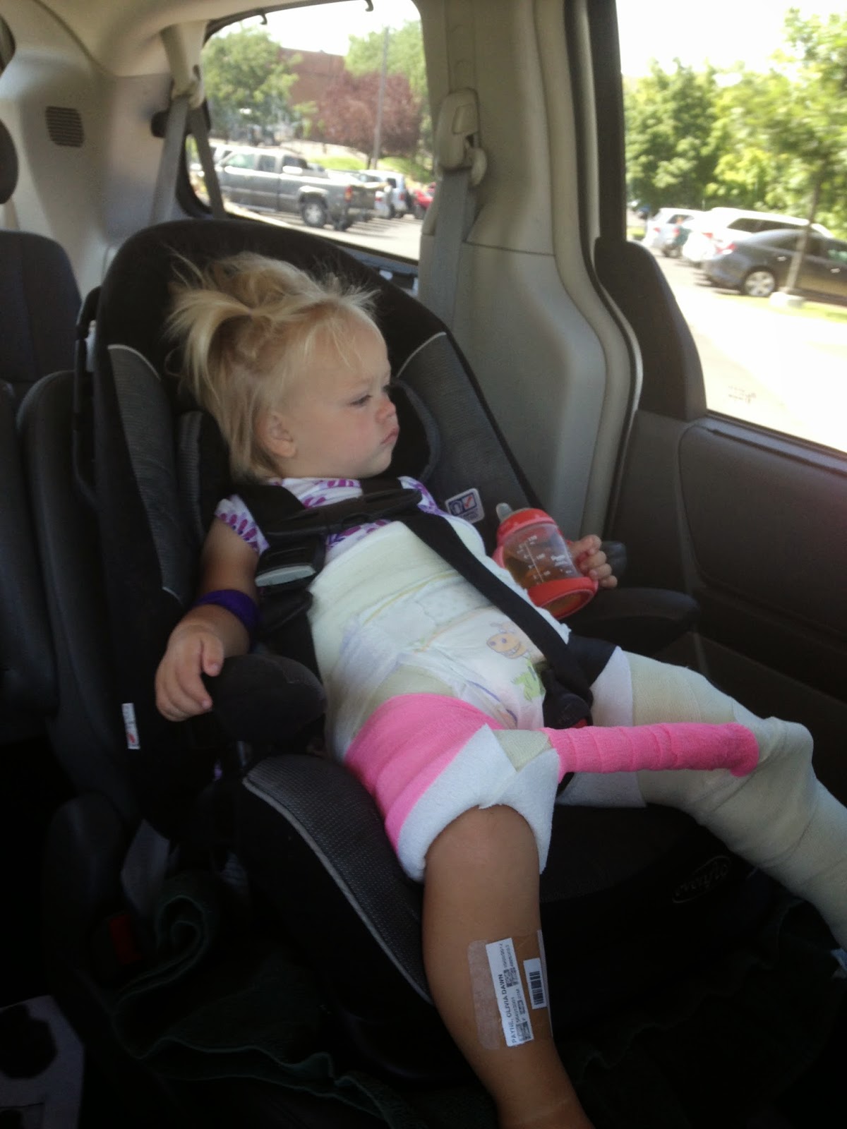 Caring for the Hip Spica Cast : Broken Femur