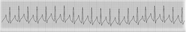 MedicEd makes it simple: Fast Rhythms_The Tachycardias