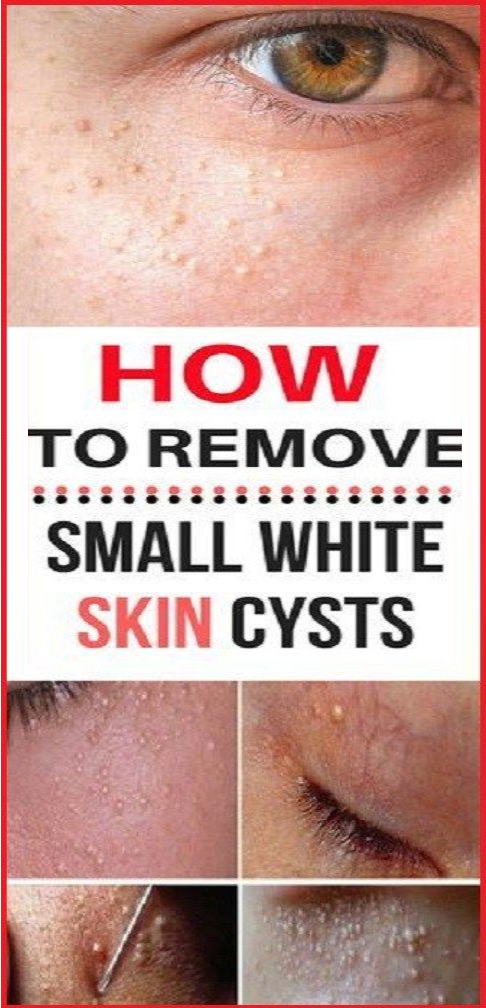 How To Remove Small White Skin Cysts Easily In Home - Healthy Lifestyle