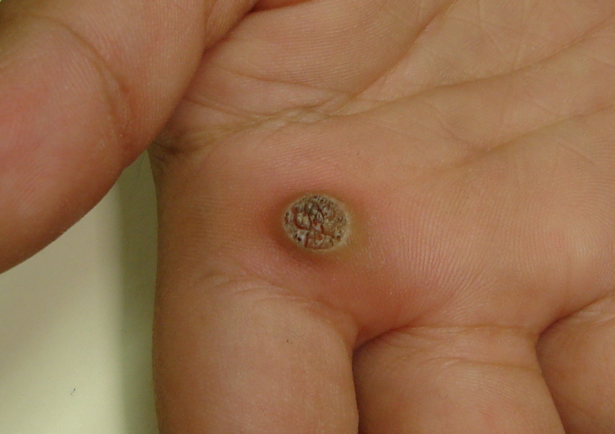 Consejos del Dermatologo: mezquino