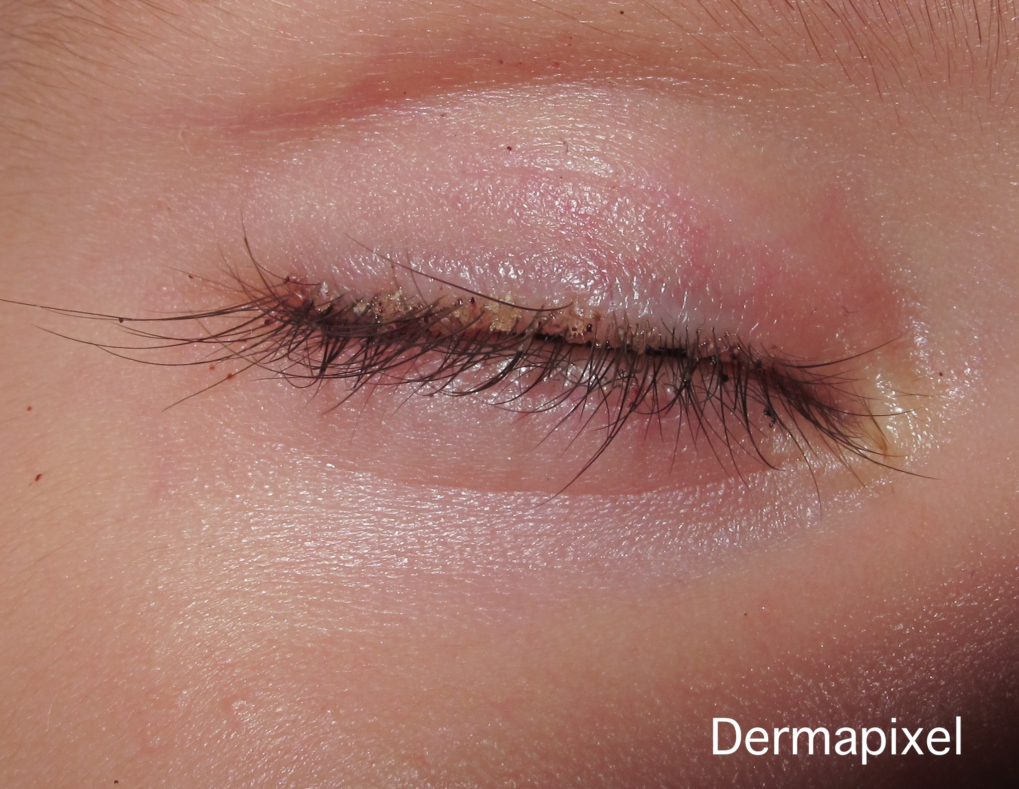Dermapixel: De ladillas, pestañas y niños