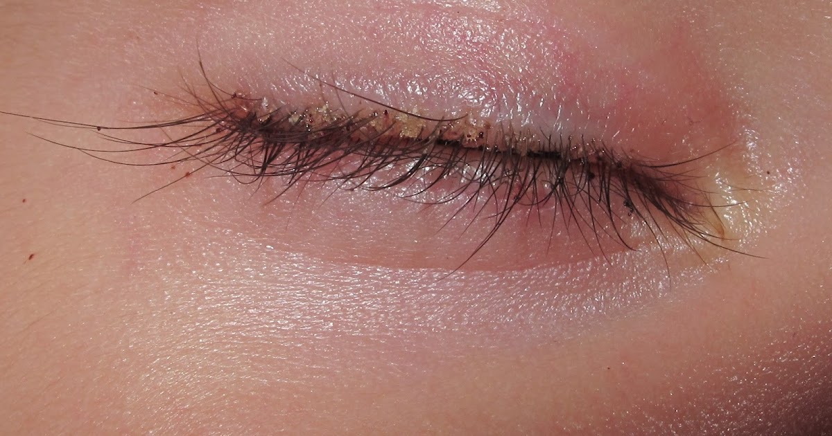 Dermapixel: De ladillas, pestañas y niños