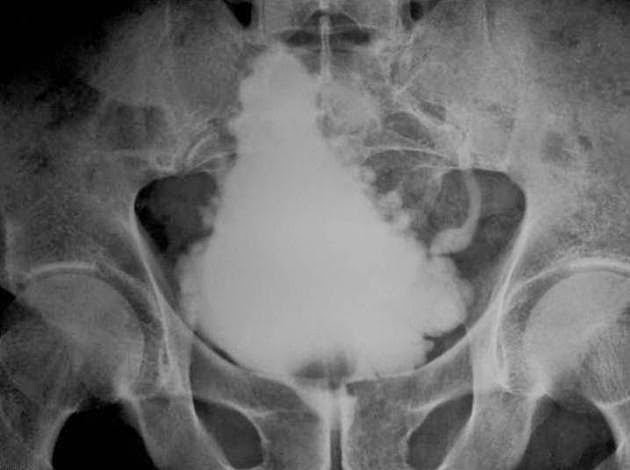 drjalmanza: PINE CONE BLADDER