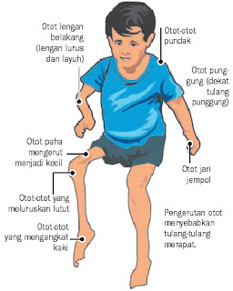 Kelainan / Penyakit pada Rangka atau Tulang | de Biology